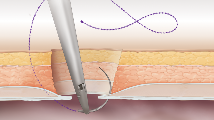 LAP and LAP-Assisted LAR | Ethicon EMEA
